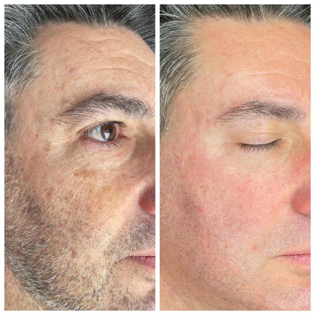 Discover the secret to flawless skin: Cosmelan Peel Treatment ...